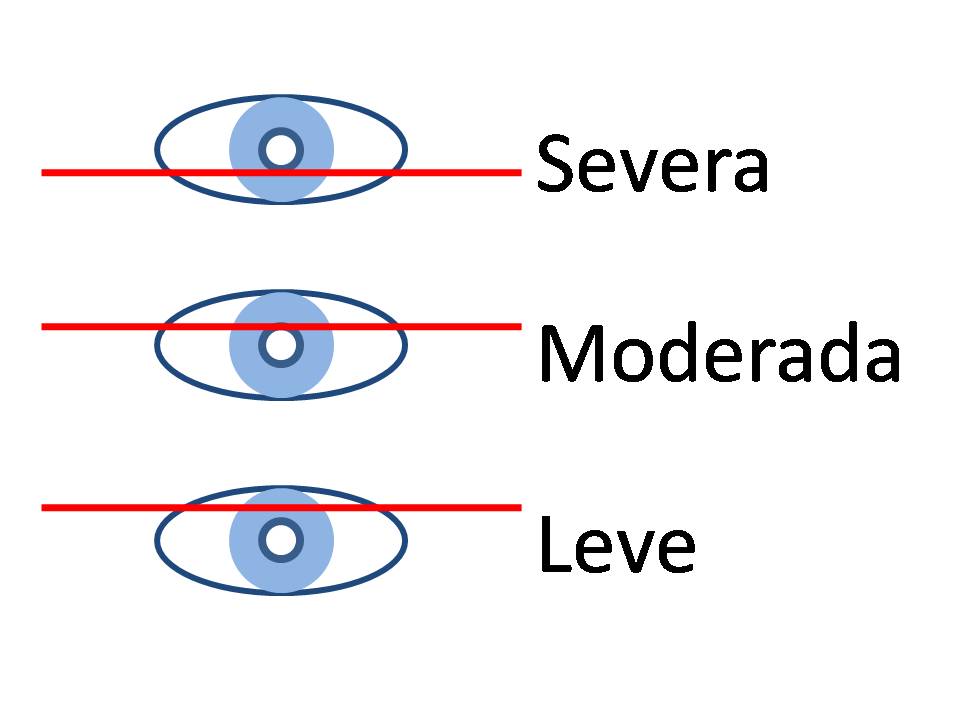 A Correção Da Ptose Adquirida | Ptose palpebral : o que é, sintomas e ...